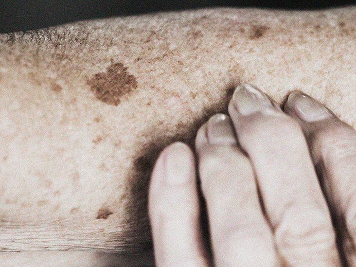 How to get rid of age spots: Home and medical treatment options