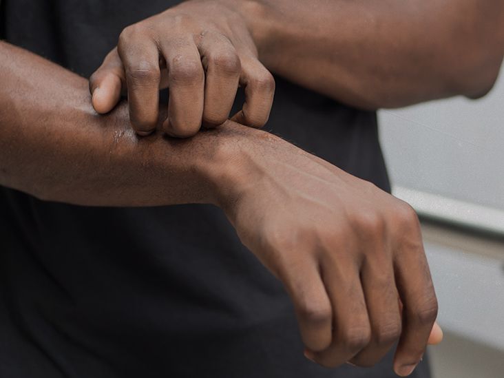 Rash on black skin: Pictures, symptoms, and treatments