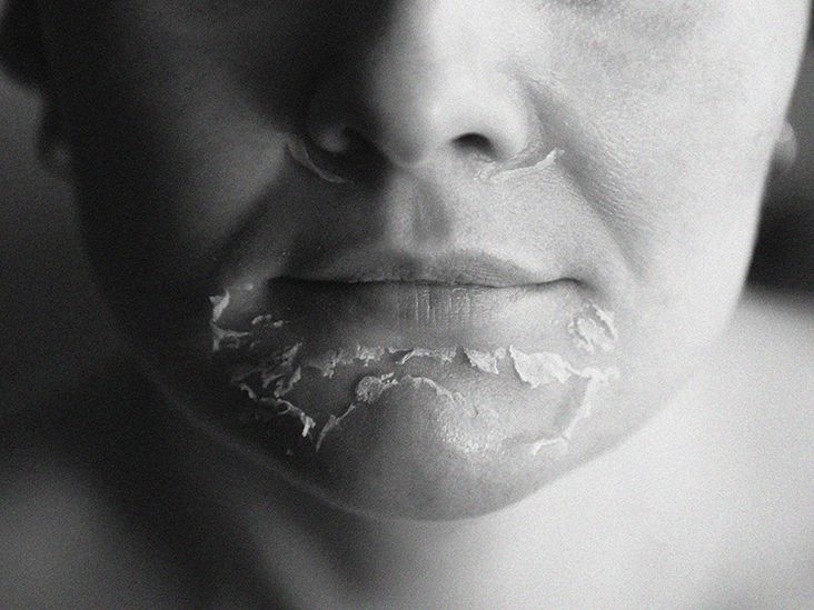 Dry skin: Causes, treatments, prevention, and more