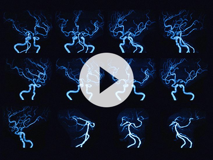 Does COVID-19 impact the brain?