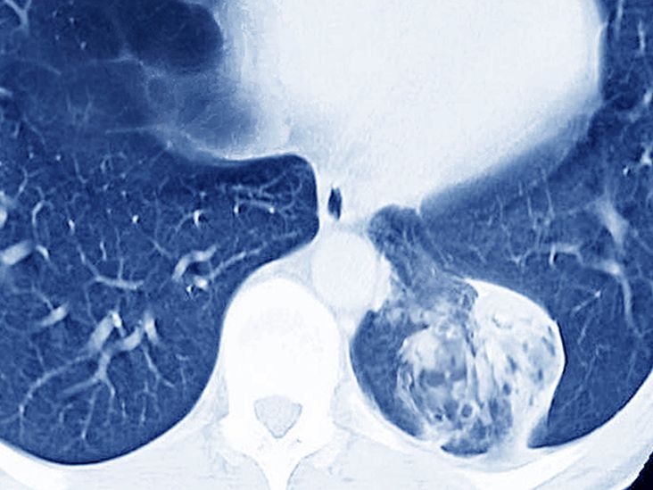Lung cancer screening guidelines: Who and how often?