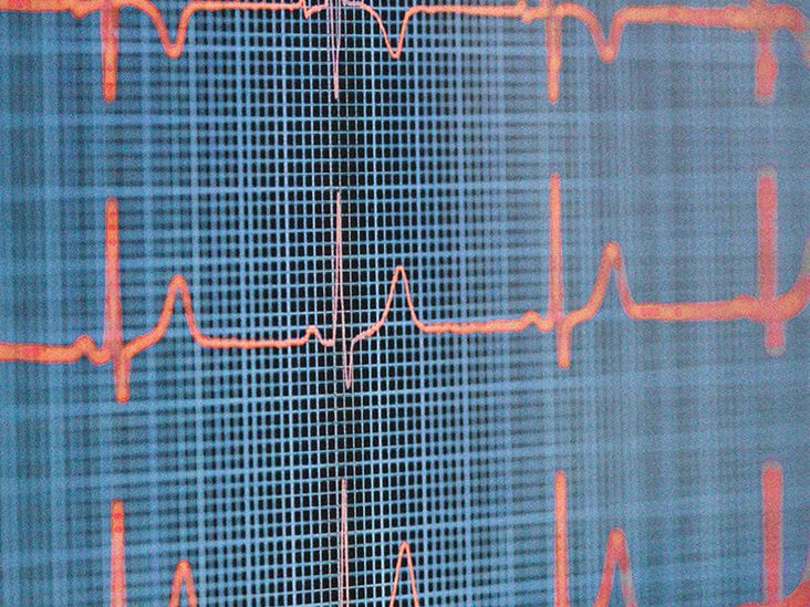 Acute heart failure: Types, symptoms, treatment, and causes