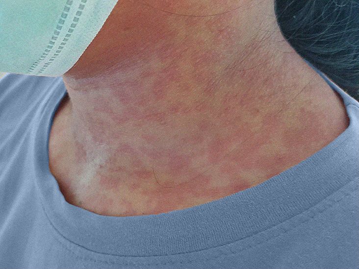 Rubella (German Measles): Symptoms, treatment, during pregnancy