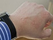 Rashes That Look Like Scabies Causes Symptoms And Treatment Rashes That Look Like Scabies Causes Symptoms And Treatment