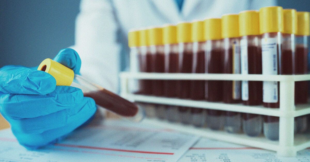 High triglycerides: Risks, causes, and treatments