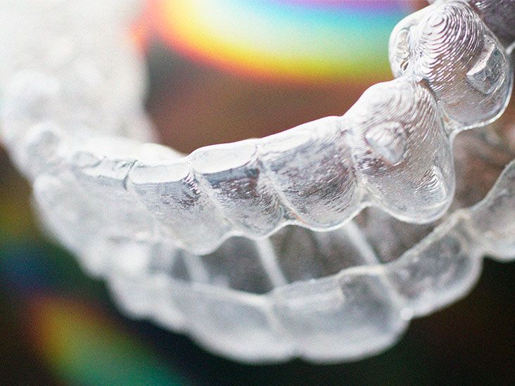 Teeth straightening retainers: What you need to know