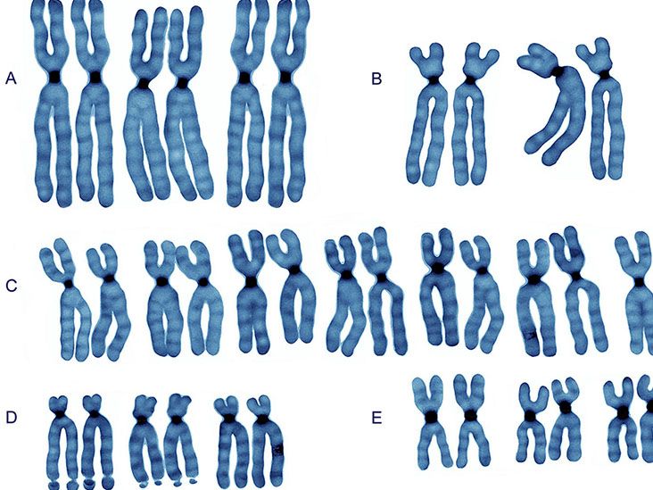 Acute myeloid leukemia karyotypes: Prognosis and more