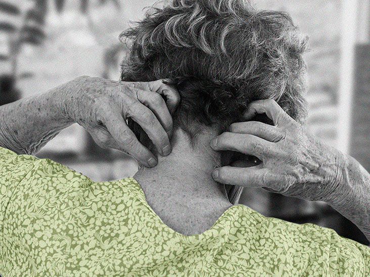 Severe psoriasis: Treatment, home remedies, and more