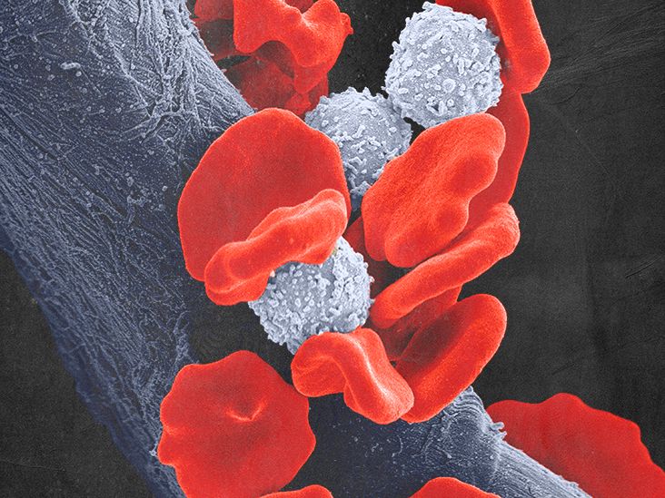 How does leukemia affect the body? Symptoms and impact