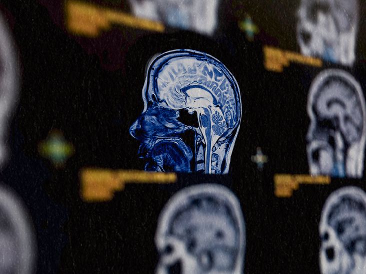 Brain embolism: Definition, symptoms, treatment, and more