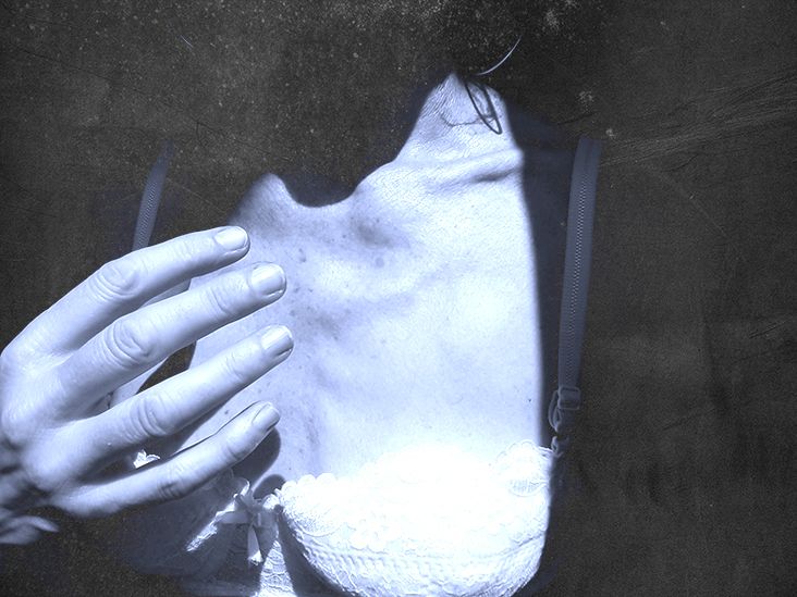 Early stage breast cancer: Symptoms, treatment, and outlook