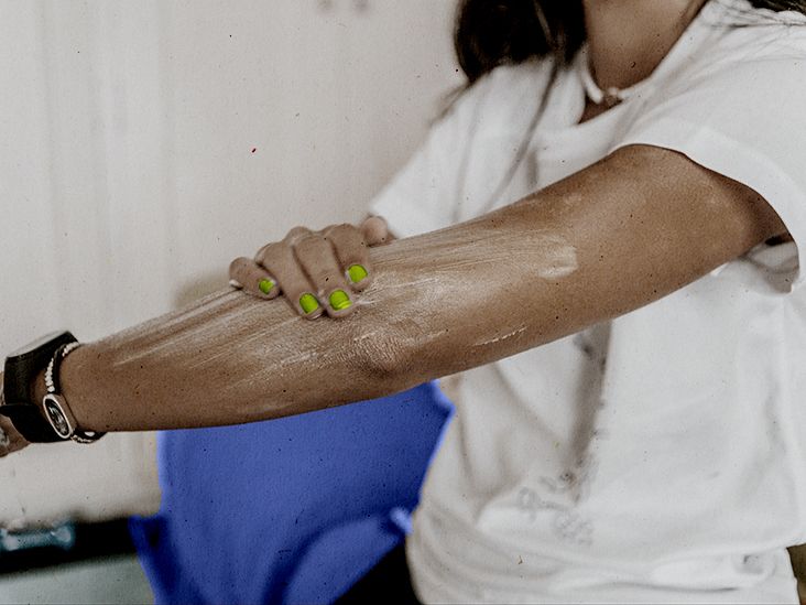 Seasonal psoriasis: Treatment tips for each season