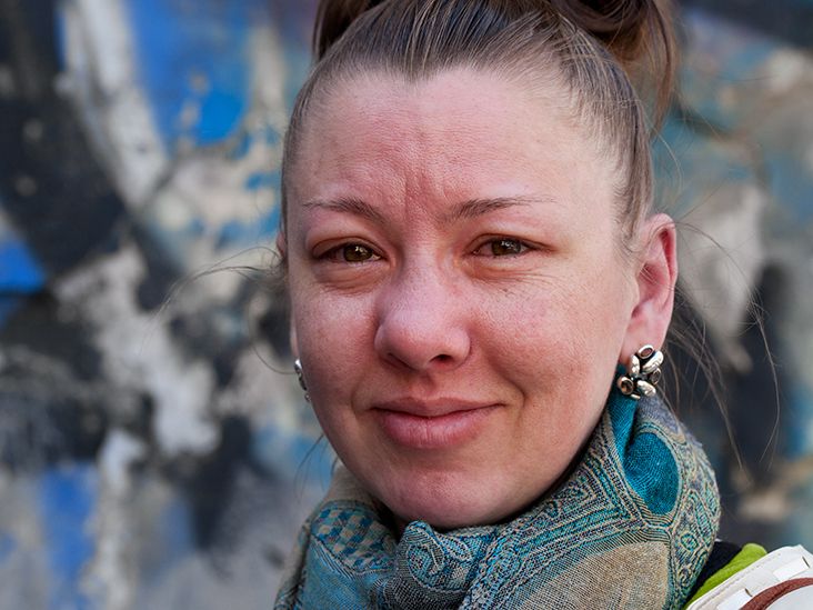 Angioedema and hives: Symptoms, causes, and treatment