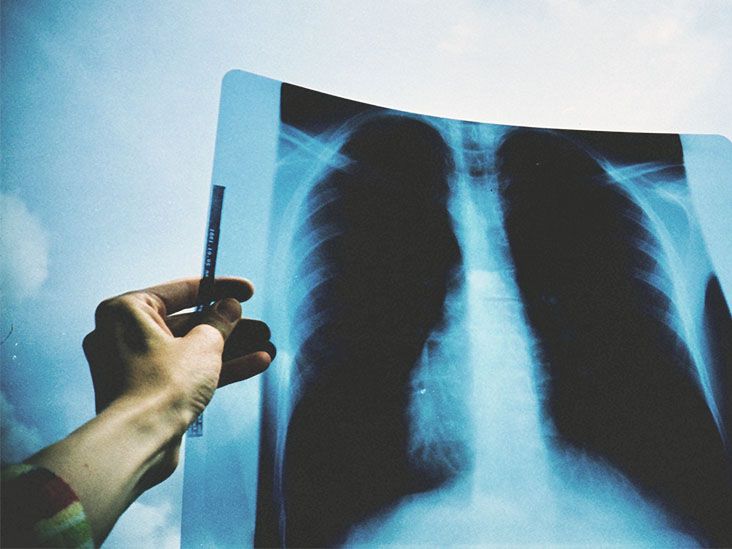 Non-small cell lung cancer: Prevalence, risks, and survival rate