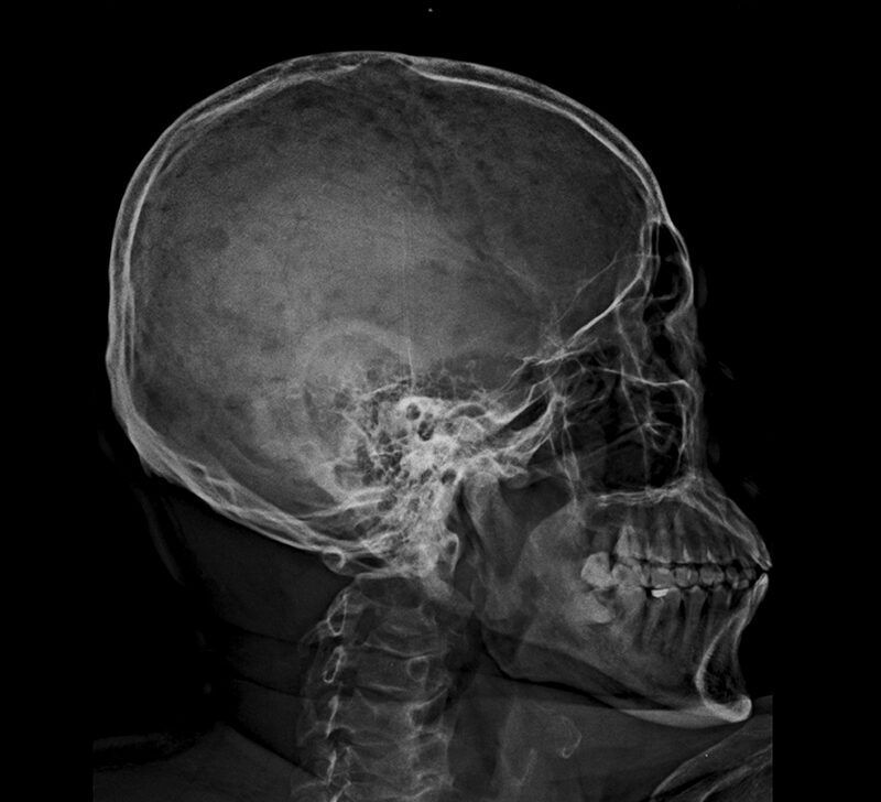 Multiple myeloma: X-rays and other imaging tests
