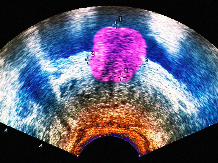 Prostate cancer vs. prostatitis: What is the relation?