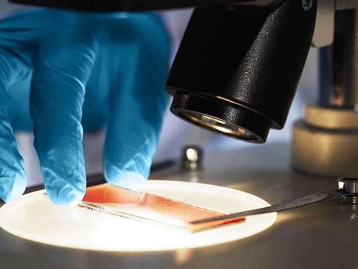 Paroxysmal nocturnal hemoglobinuria (PNH): Symptoms and diagnosis