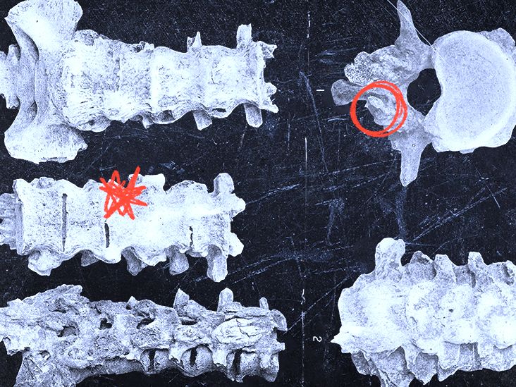 Spondylitis: Types, symptoms, diagnosis, and treatment