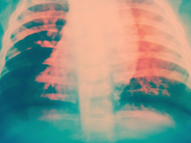 Pulmonary hypertension diagnosis: Tests, criteria, what to expect
