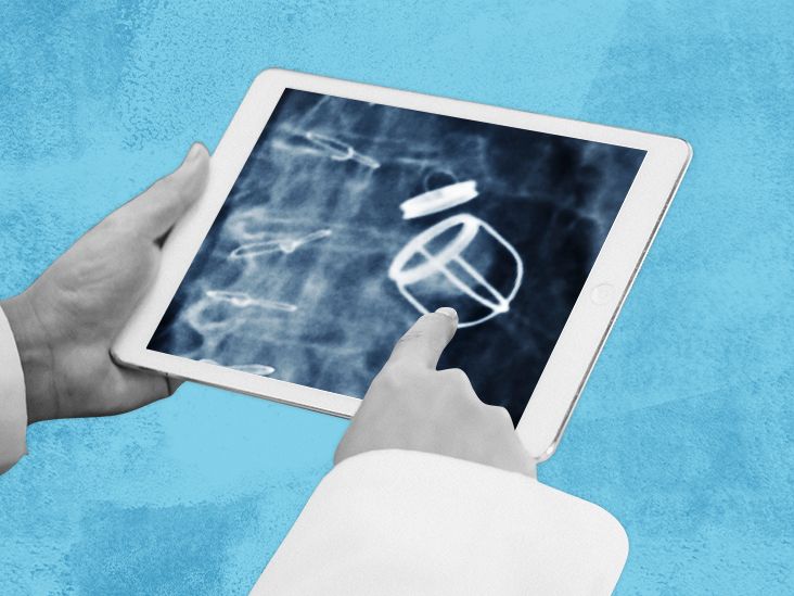 Zephyr Valve treatment review: Uses, benefits, and risks