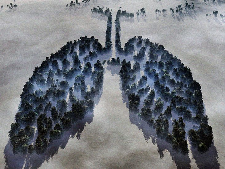 Pulmonary interstitial emphysema: Types and treatment