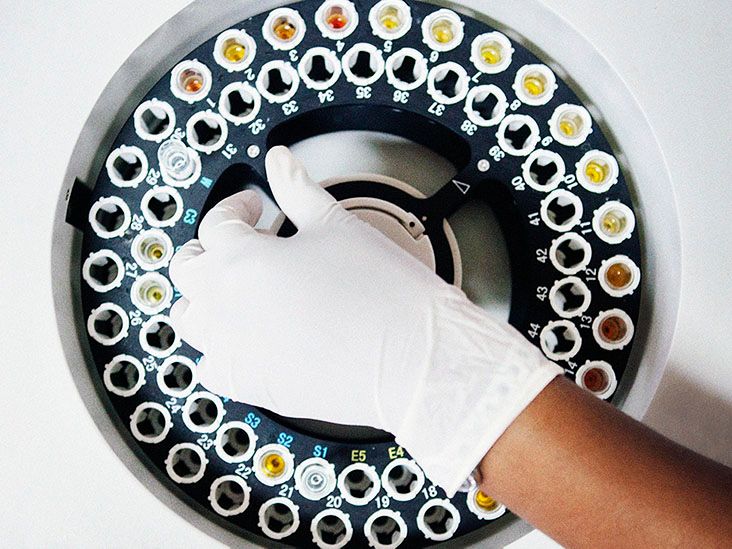 Homocysteine levels: What it means, symptoms, treatment