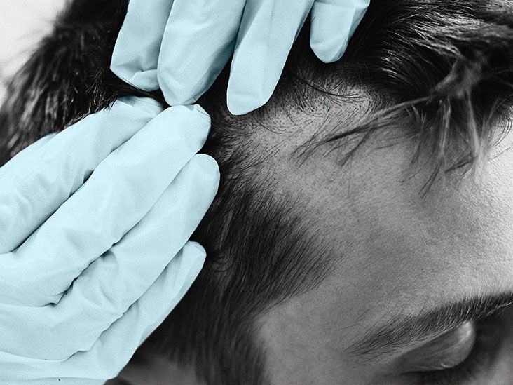 Auspitz sign in psoriasis: Symptoms, causes, treatment & more