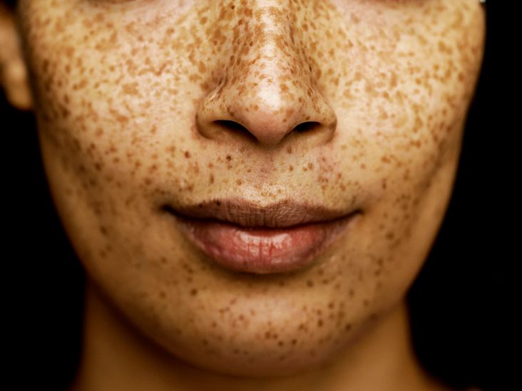 Chemical peels for freckles: Results, risks, costs, and more