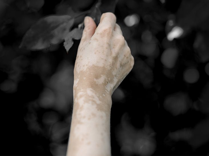 Melasma: Causes, symptoms, pictures & treatment