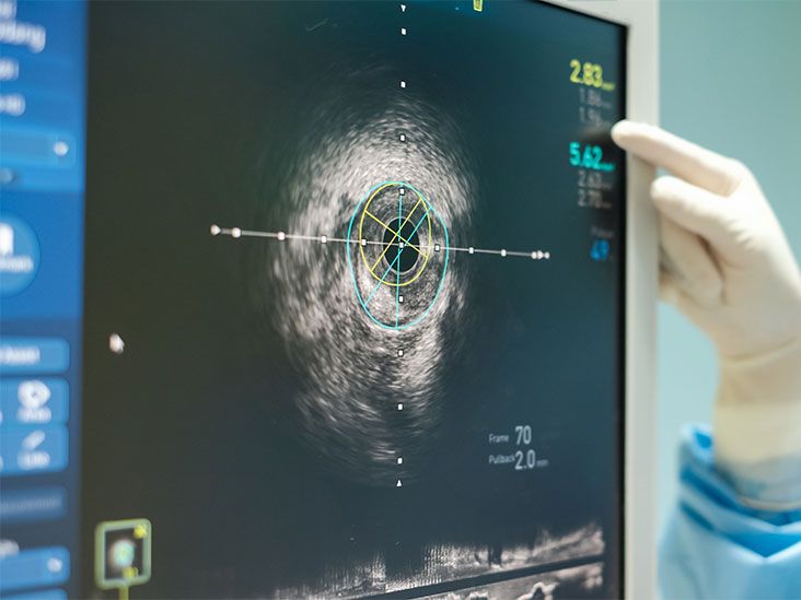 Everything to know about coronary calcium scans
