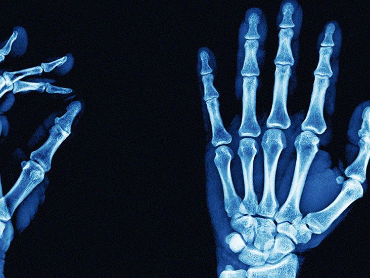 Synovitis and psoriatic arthritis: Similarities and differences