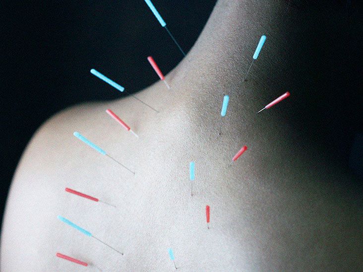 Acupuncture for neck pain: Does it work?