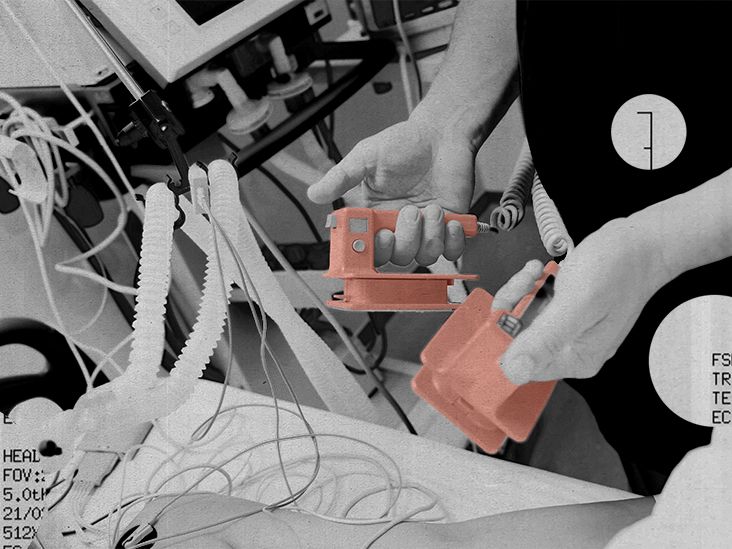 Cardioversion: Procedure, side effects, and recovery