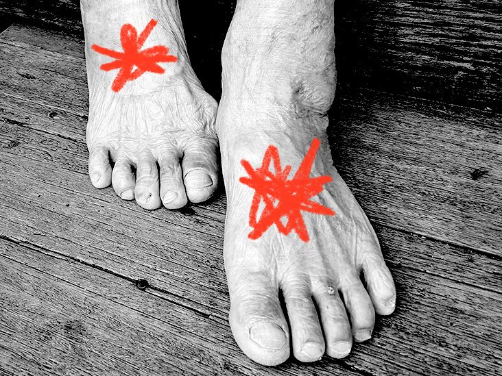 Midfoot arthritis: Symptoms, causes, and treatment