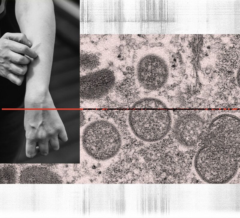 Monkeypox virus: Symptoms, outbreaks, and treatment