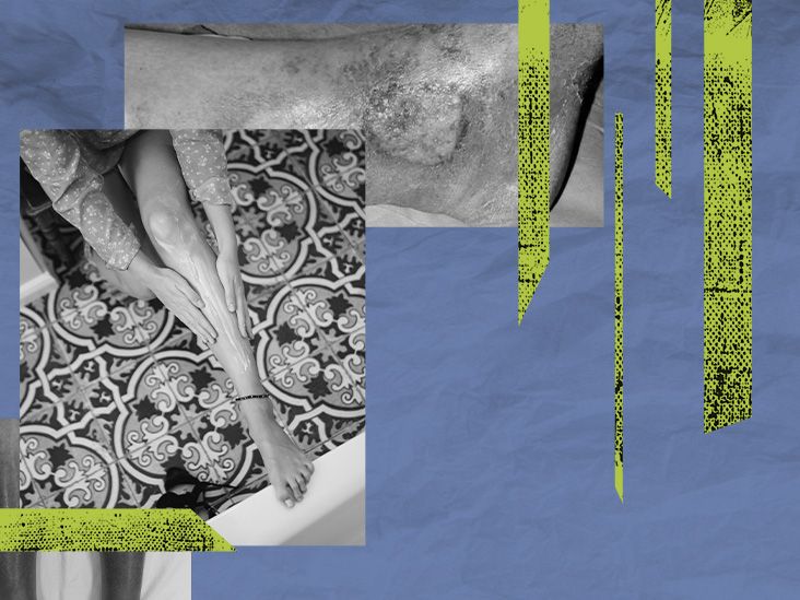 Varicose eczema or stasis dermatitis: Symptoms, causes, and treatment