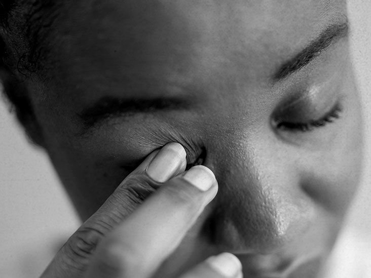 Beginning stages of an eye stye, prevention, and treatments