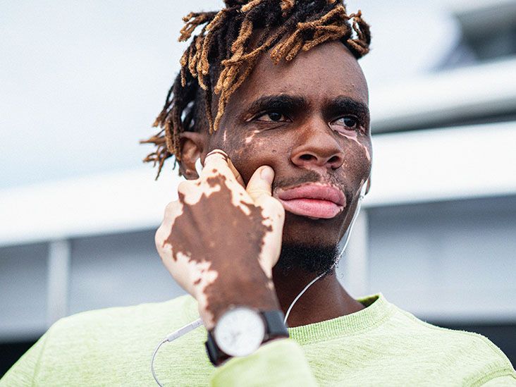 Vitiligo and COVID-19 vaccine: Links and more
