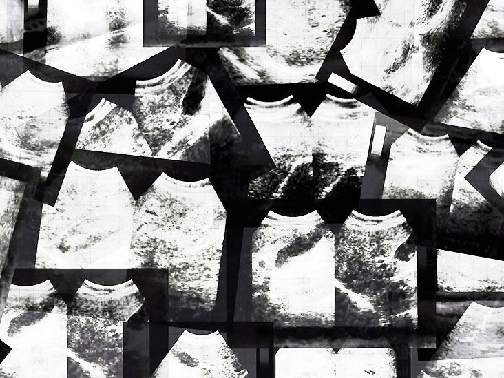 Cholesterolosis of gallbladder: What it is, symptoms, and treatment