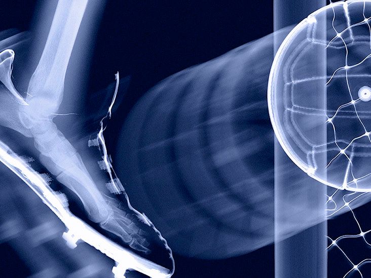 Jones fracture: Treatment, symptoms, pictures, and healing