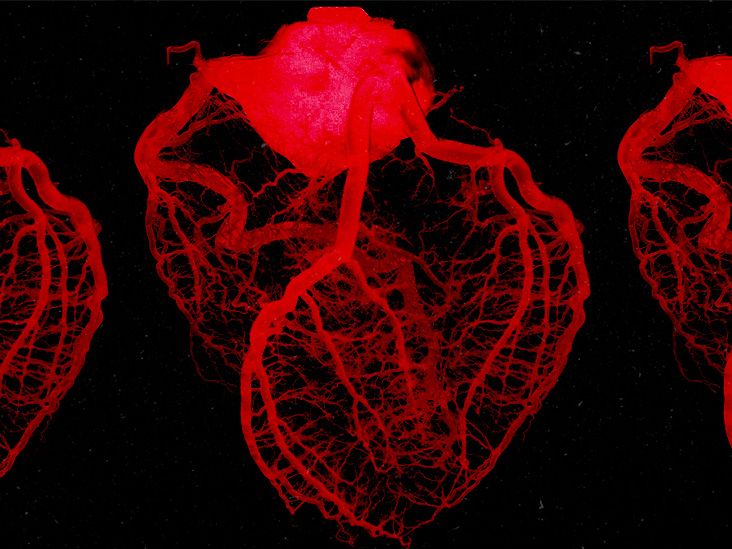 Mobitz type II heart block: Causes, symptoms, and treatment