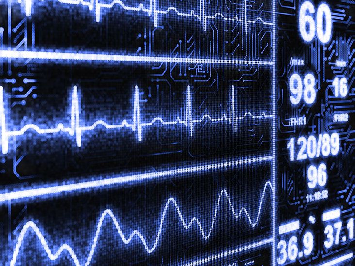 1st degree ventricular block: Causes, symptoms, and treatment