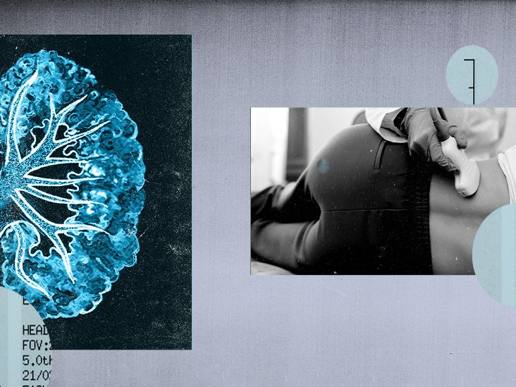 Medullary sponge kidney: Symptoms, diagnosis, and more