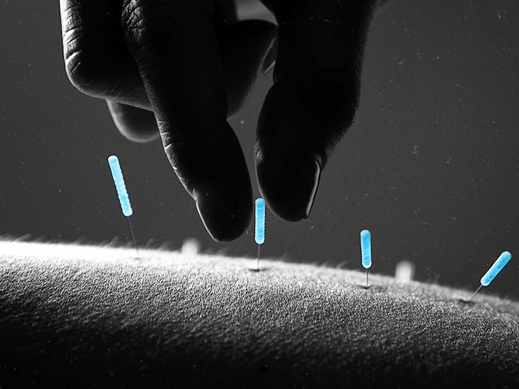 Acupuncture could help reduce type 2 diabetes risk