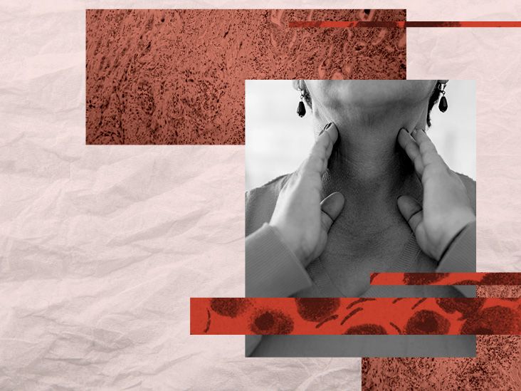 Anaplastic Thyroid Cancer Symptoms Treatment Survival And More 4426