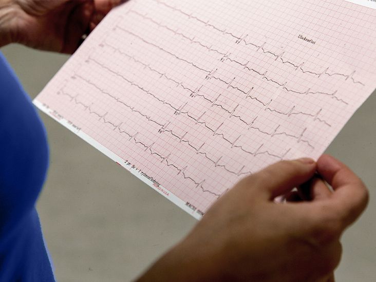 ST segment depression: Definition, causes, treatments