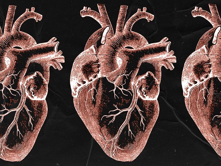 Mobitz type 1 heart block: Causes, symptoms, and treatment