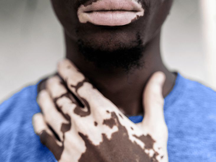 Equity in dermatology: Visual representation of darker skin is key