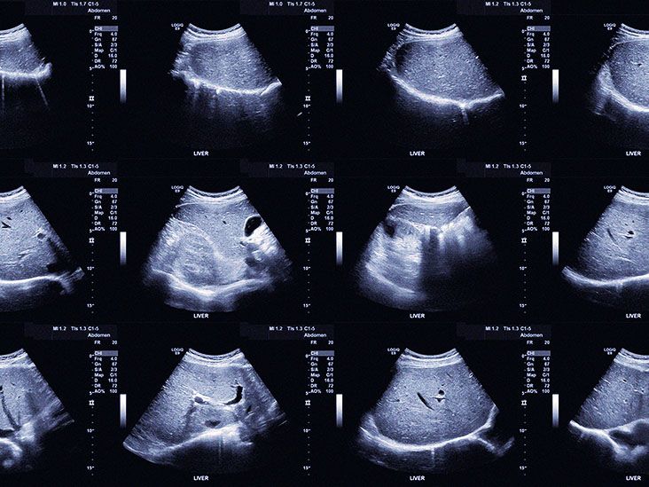 Budd-Chiari syndrome: Symptoms and treatments