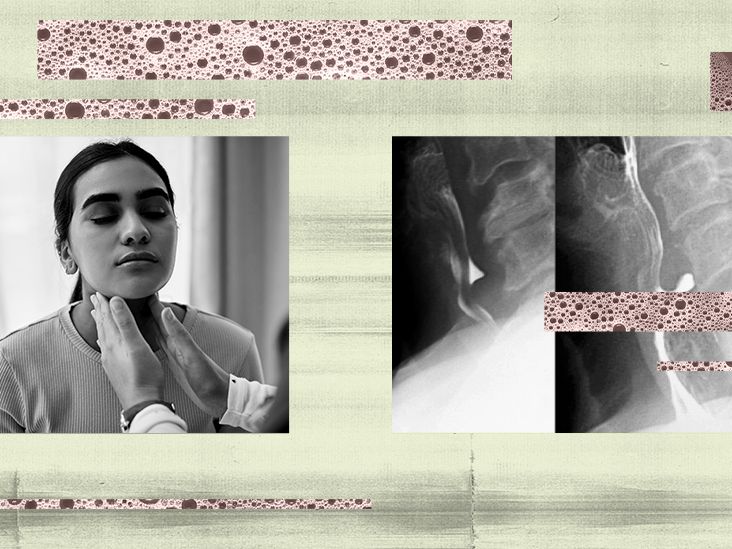 Zenker Diverticulum Images Pathology And Treatment Of Zenker